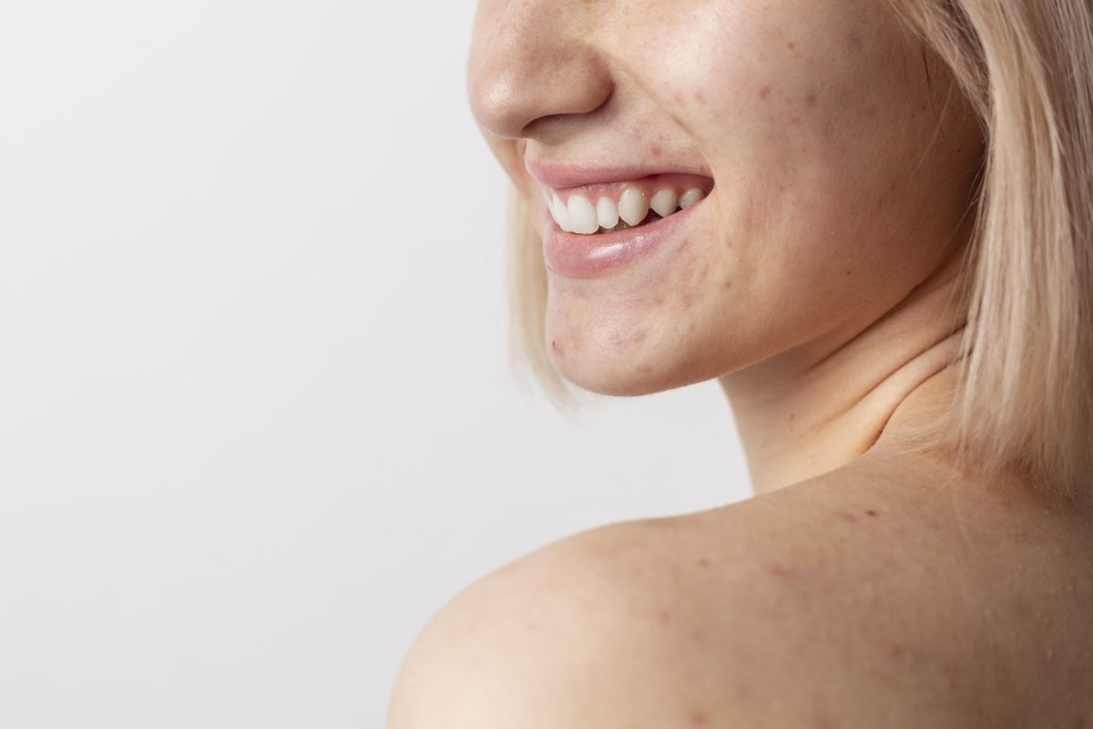 Understanding Acne Diagnosis and Clinical Management